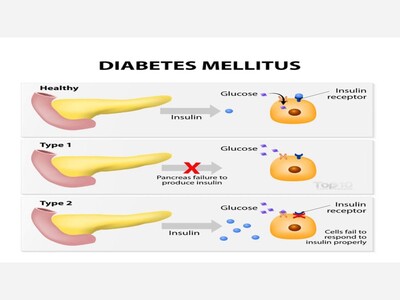 Brittle Diabetes | The Los Angeles News.
